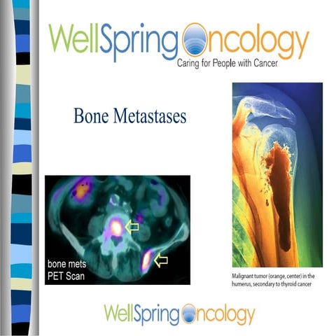 Bone mets video | PPT