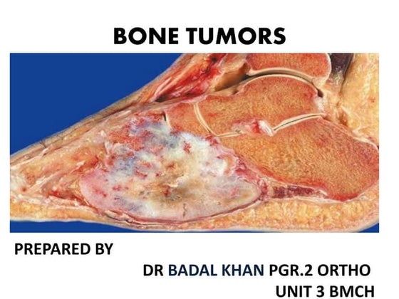 Types of Bone Cancer | PPT