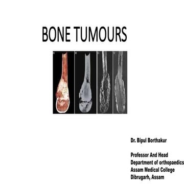 LONG BONE TUMOURS ORTHOPAEDICS ,PPTX.... | PPT