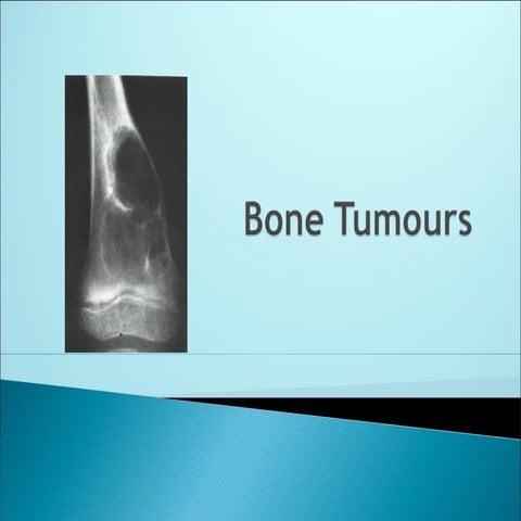 Bone tumours | PPT