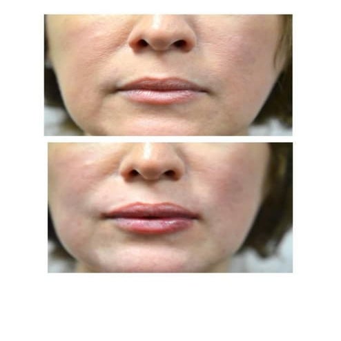 Botox And Fillers Pdf