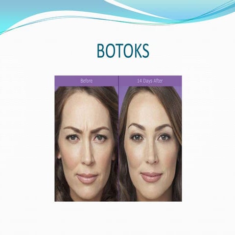 Botox slide | PPTX