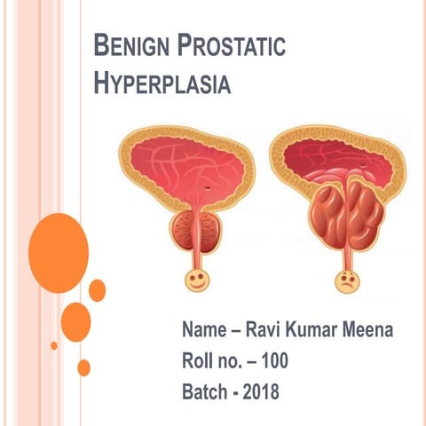 Benign Prostatic Hyperplasia by Dr Ravi Meena | PPT