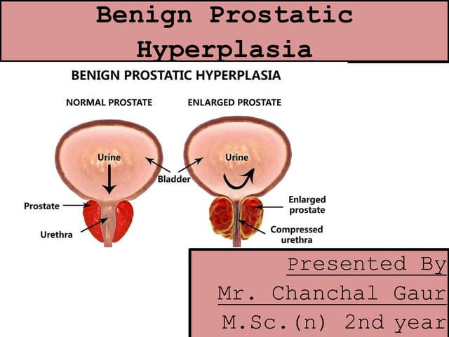 Benign prostatic hyperplasia (BPH) | PPTX