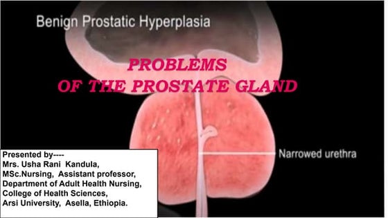 Benign prostatic hyperplasia (BPH) | PPT