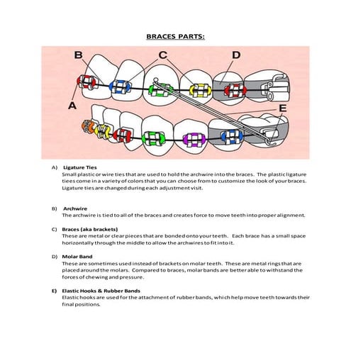 Braces parts | PDF