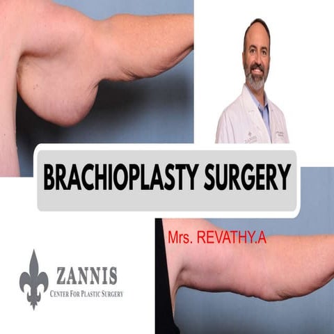 Brachioplasty | PPTX