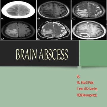 Brain abscess | PPTX