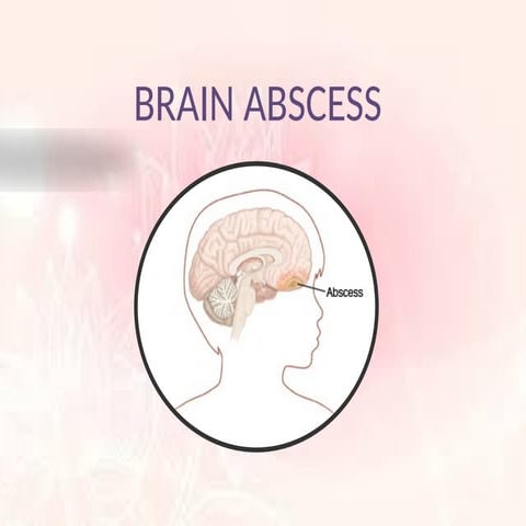 BRAIN ABSCESS.pptx dsgswgewgwhtRGTWGRGRDT | PPT
