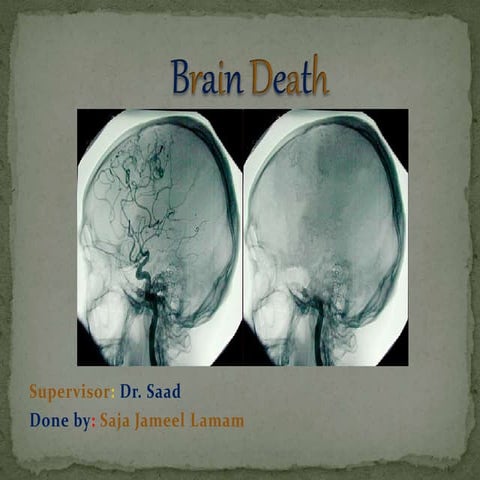 Brain death | PPTX