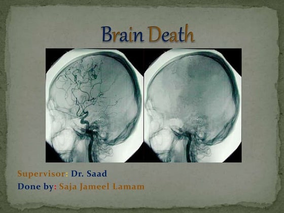 Brain death | PPTX | Brain and Nervous System Disorders | Diseases and Conditions