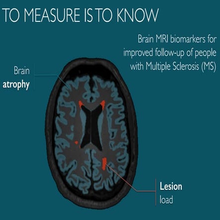 Brain MRI biomarkers for improved follow up of people with Multiple ...
