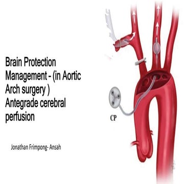 Brain Protection Management – (in Aortic Arch.pptx