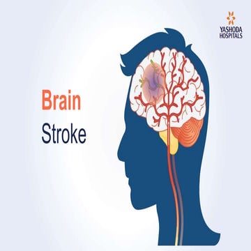 Brain stroke treatment | Yashoda Hospitals | PPTX