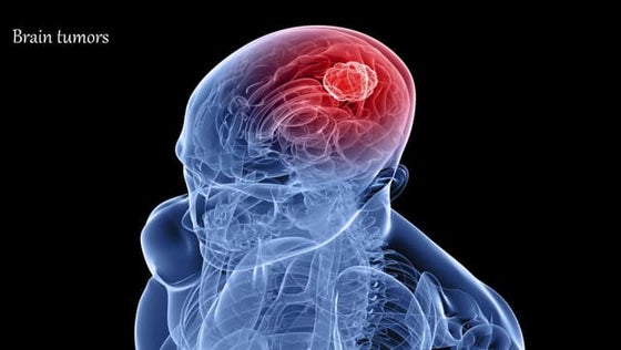 brain tumor info.pdf