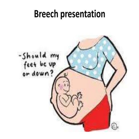 breech-presentation.ppt
