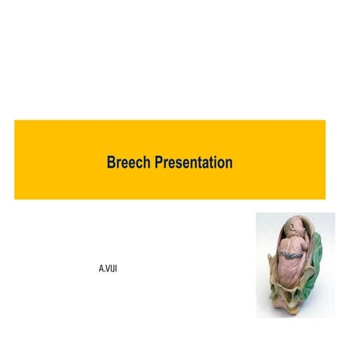 Breech mech of labour | PPTX