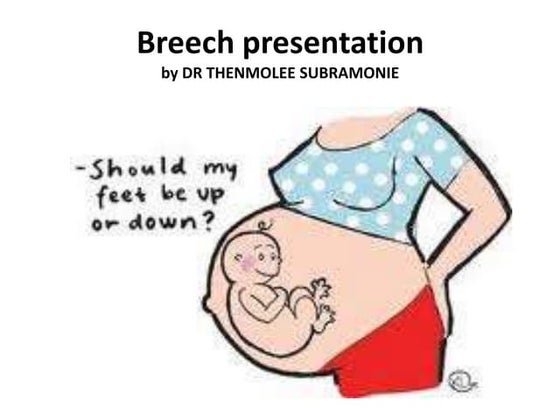 24-breech.ppt breech presentation mechanism | PPT