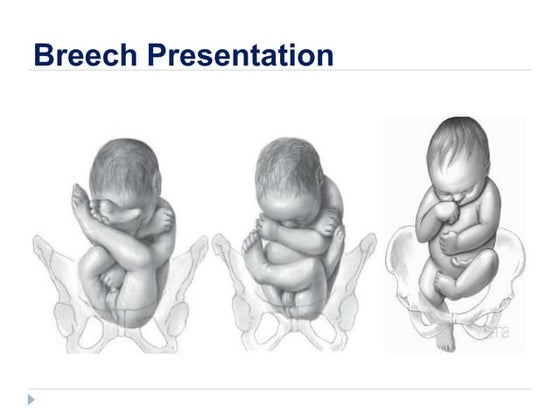 Breech mech of labour | PPTX | Pregnancy | Reproductive Health