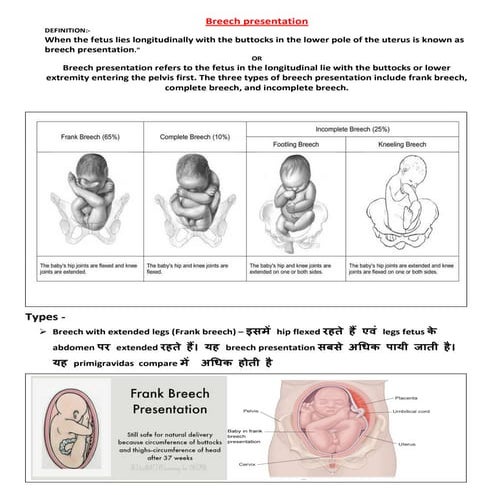 Frank Breech Presentation Breech Positions TrialQuest Inc.