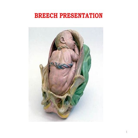 Breech Presentation 12.pptxggggbcxxxcccc | PPTX