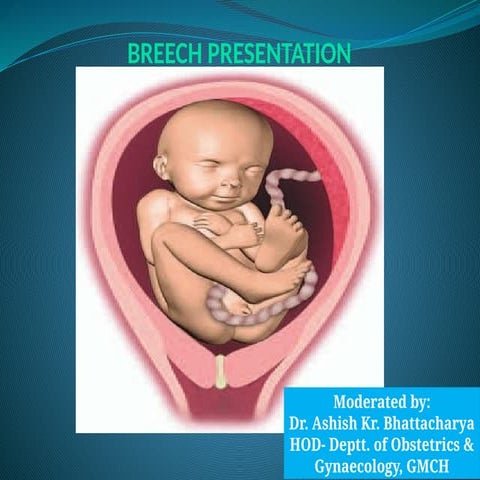 breech presentation final.pptxvhhb. vh.v | PPTX