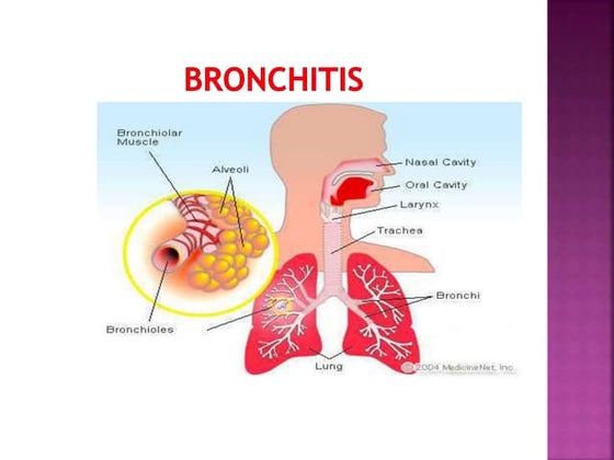Bronchitis | PPT | Lung and Respiratory Health | Diseases and Conditions