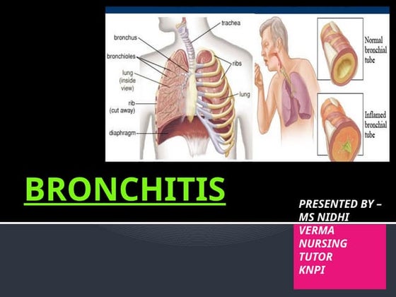 Bronchitis | PPT | Lung and Respiratory Health | Diseases and Conditions