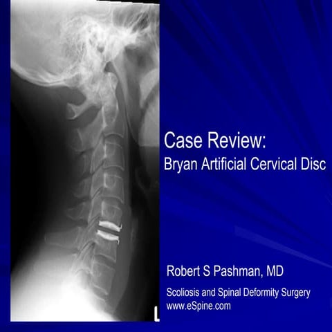 Case Review #9: 40 year old female treated with a Bryan Cervical Disc | PDF