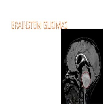 Brain Stem Glioma Tumor Mri Brainstem Glioma | PPTX