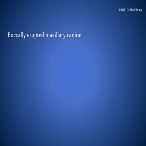 Buccally erupted maxillary canine | PPTX