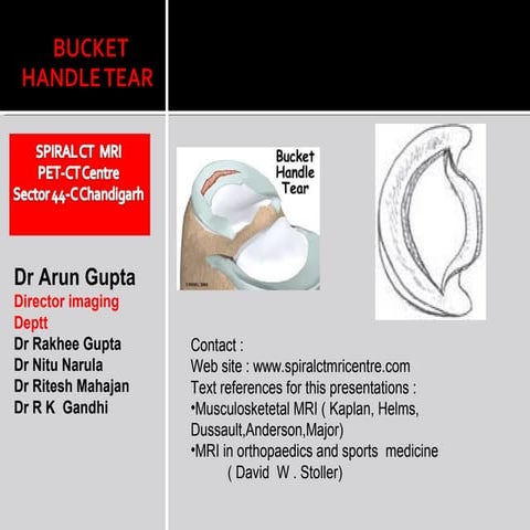 Bucket handle tear | PPT