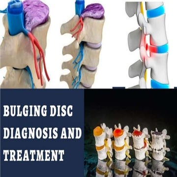 Bulging Disc Diagnosis and Treatment.pptx