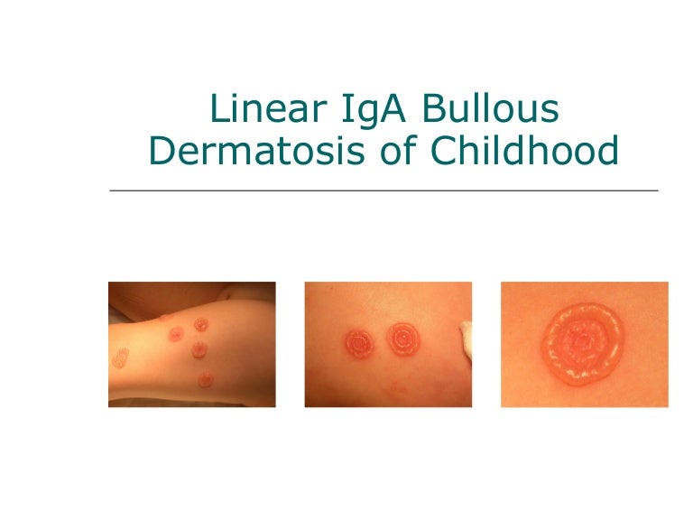 Linear IgA bullous dermatosis II