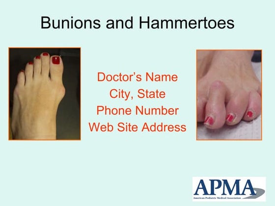 Hammertoes | PDF