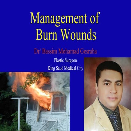 Clinical formula for management of pediatric scald burn | PPTX