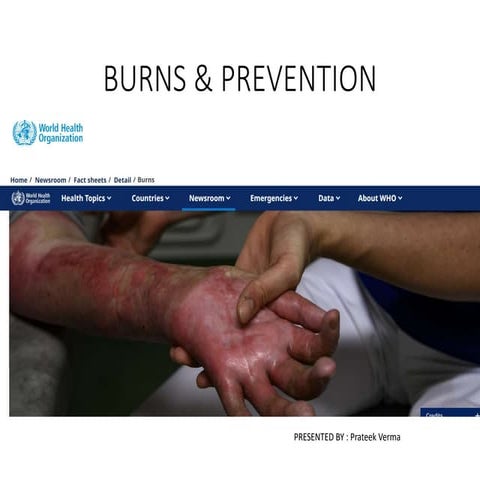 Burns , Guidelines, protocols and Management.pptx
