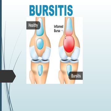 bursitis-definition, causes, risk factorsmedical management | PPTX