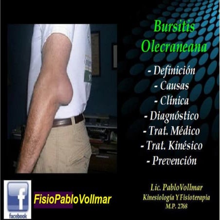 Bursitis de codo Bursitis Olecraneana Pablo Vollmar.PDF