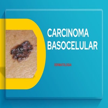Melanoma y cancer basocelular presentacion | PPTX