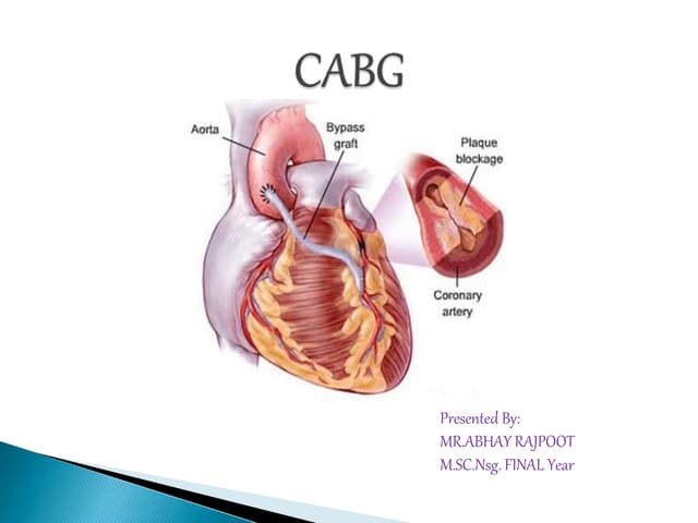 CABG | PPT