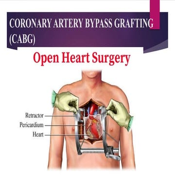 CABG | PPT