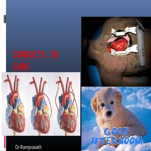 condiuts in Coronary artery bypass grafting | PPT