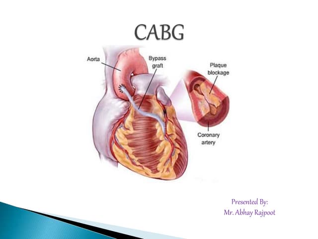 CABG | PPT