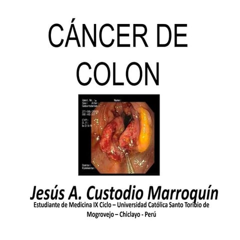 Cáncer de colon y recto | PPT