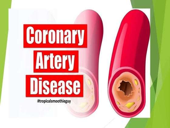 coronary artery disease (CAD) | PPT