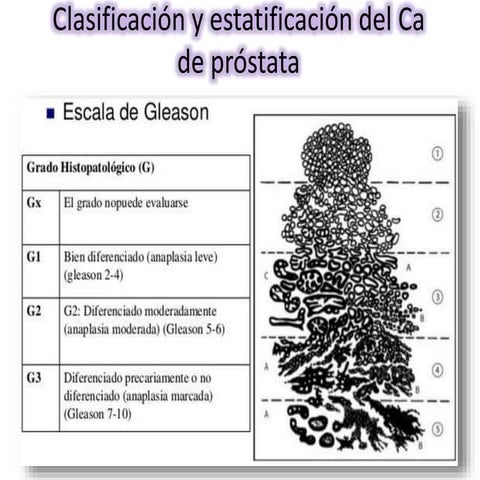 Clasificación del Cáncer de próstata. | PPTX