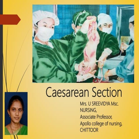 Caesarean section | PPTX