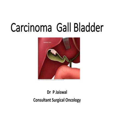 Carcinoma Gall bladder | PPT | Cancer | Diseases and Conditions