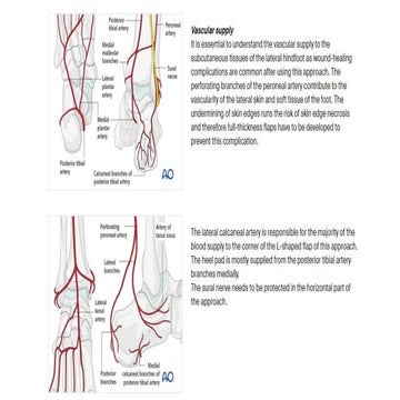 Calcaneal approach, dangerasdsadsdadsadsa.pptx